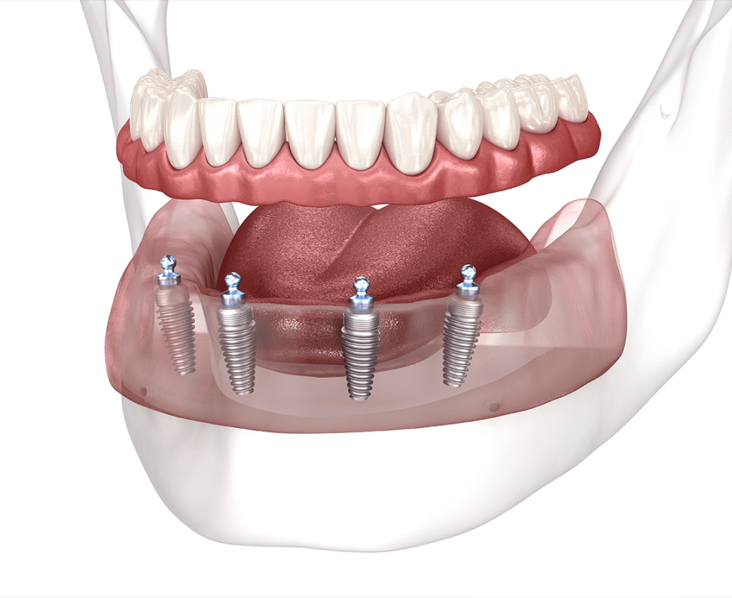 All-on-Four Treatment - MAYADENT